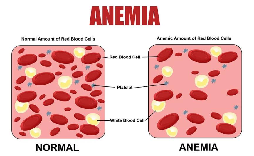 Anemia por déficit de hierro | Periódico Mi Tierra
